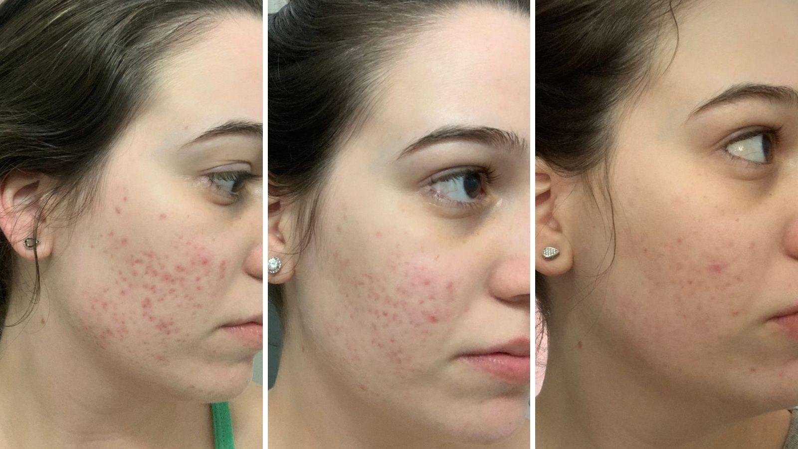 Como Clarear Manchas De Acne Veja Tratamentos E Formas De Prevenção
